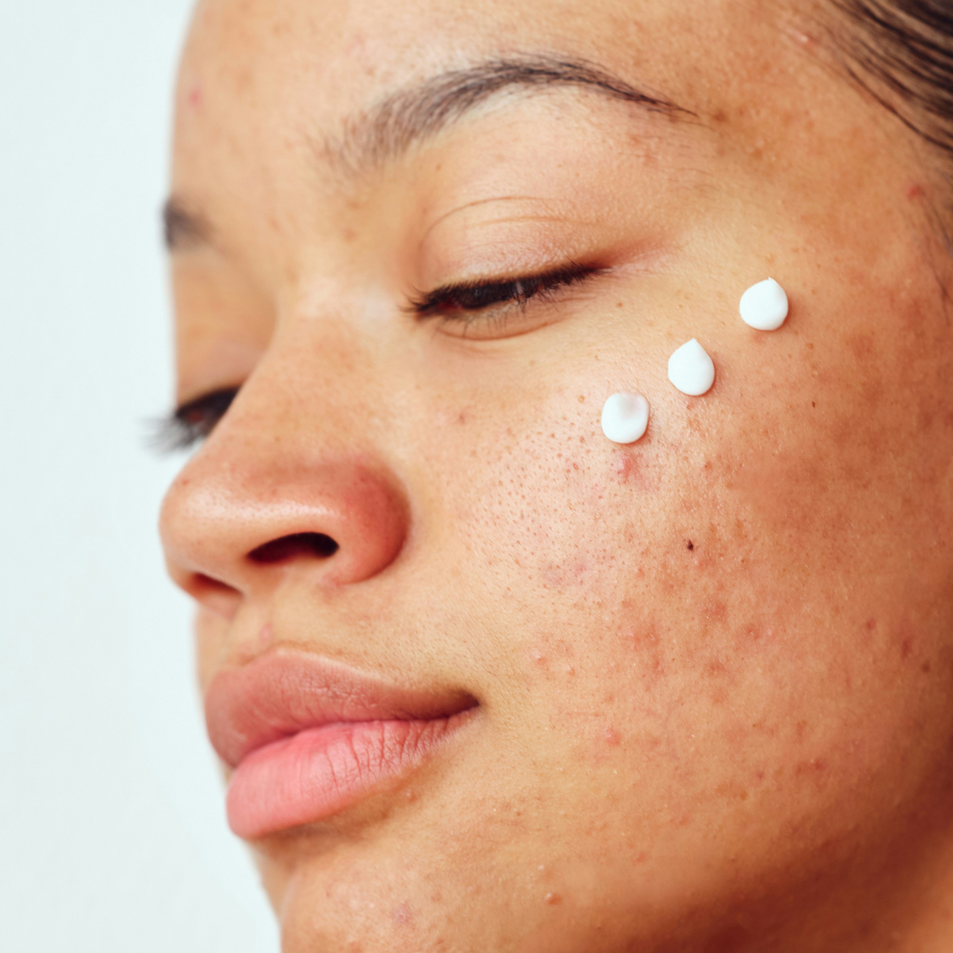 Exploring the Benefits of Niacinamide for Acne-Prone Skin – YUNI Beauty